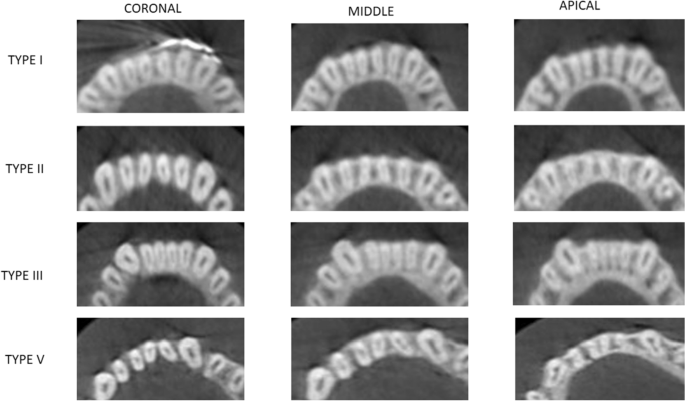 Distolingual root prevalence in mandibular first molar and complex